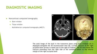 Skull fractures in adults | PPTX
