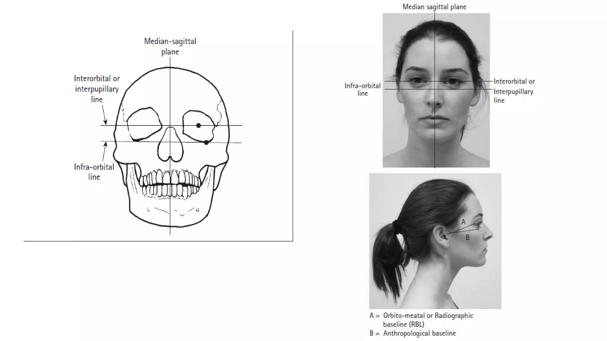 Skull,orbit temporal bones,facial bones,paranasal sinuses,mandible and ...