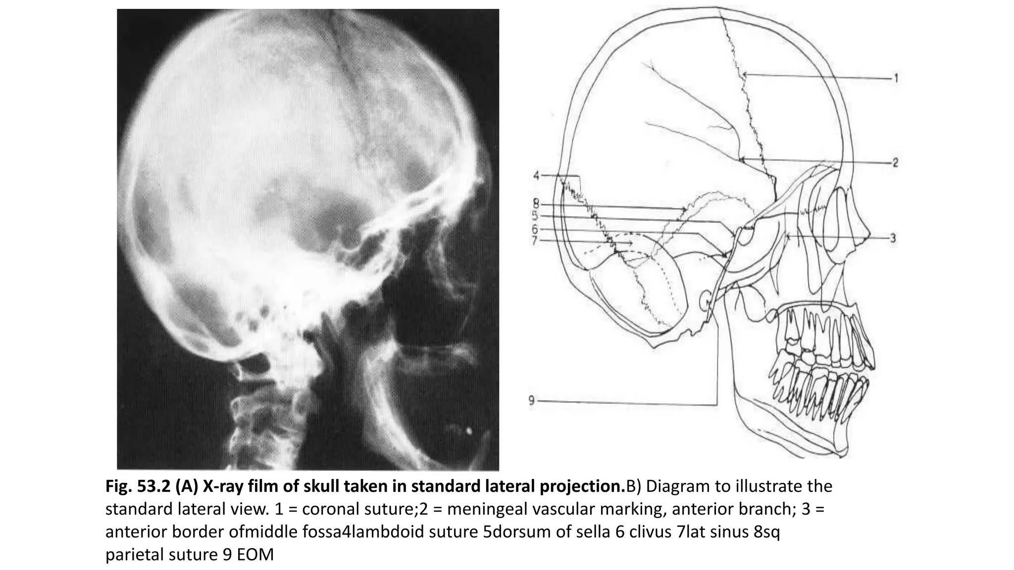 Skull,orbit temporal bones,facial bones,paranasal sinuses,mandible and ...