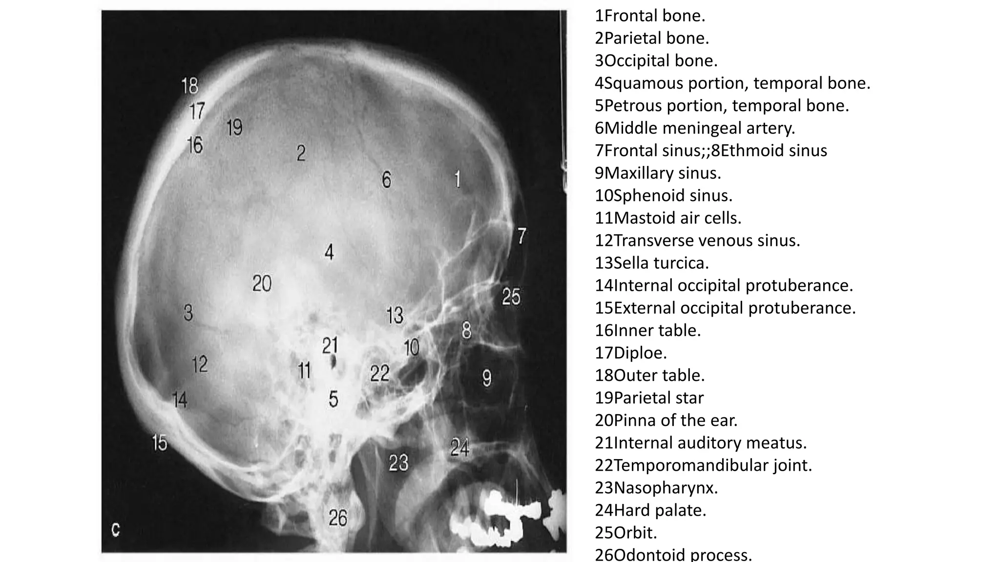 Skull,orbit temporal bones,facial bones,paranasal sinuses,mandible and ...