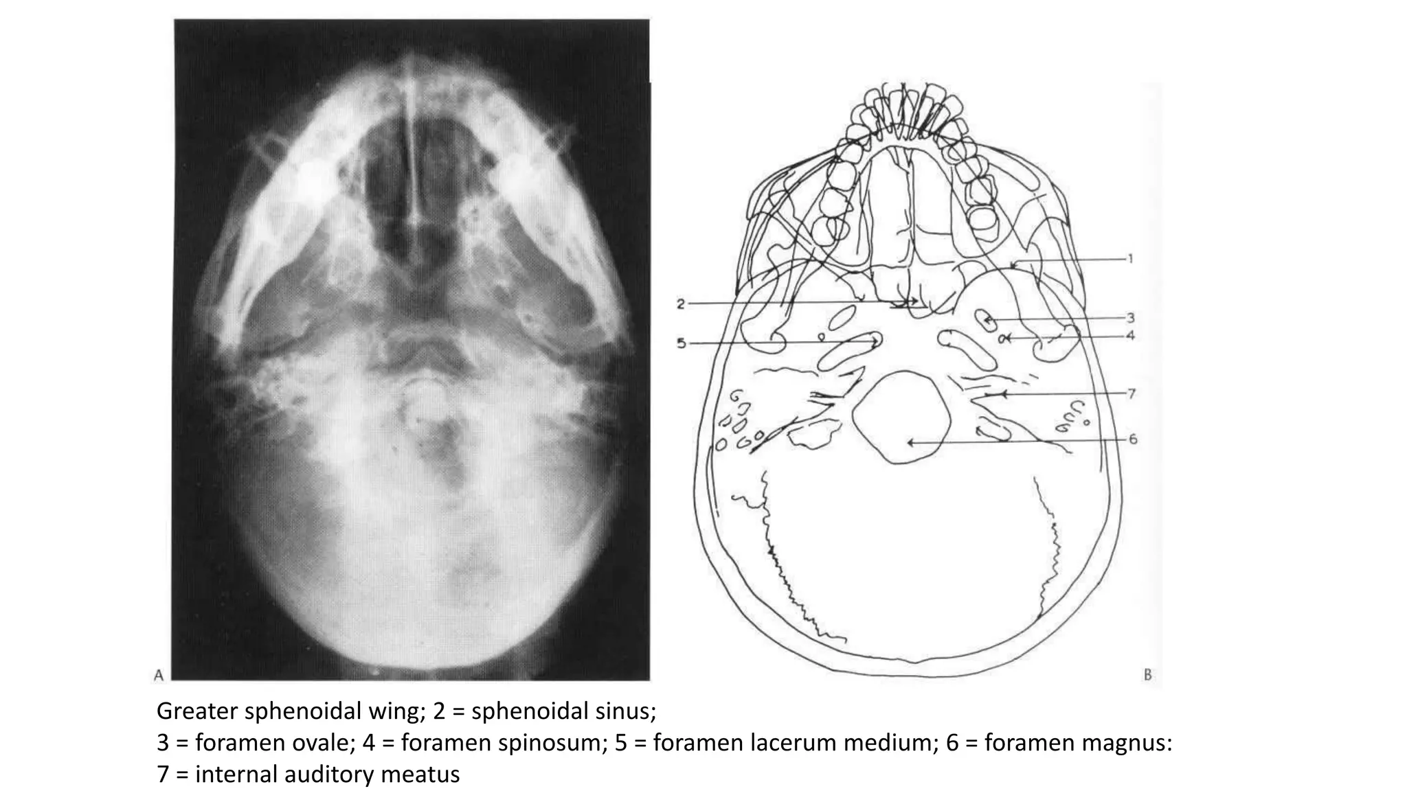 Skull,orbit temporal bones,facial bones,paranasal sinuses,mandible and ...