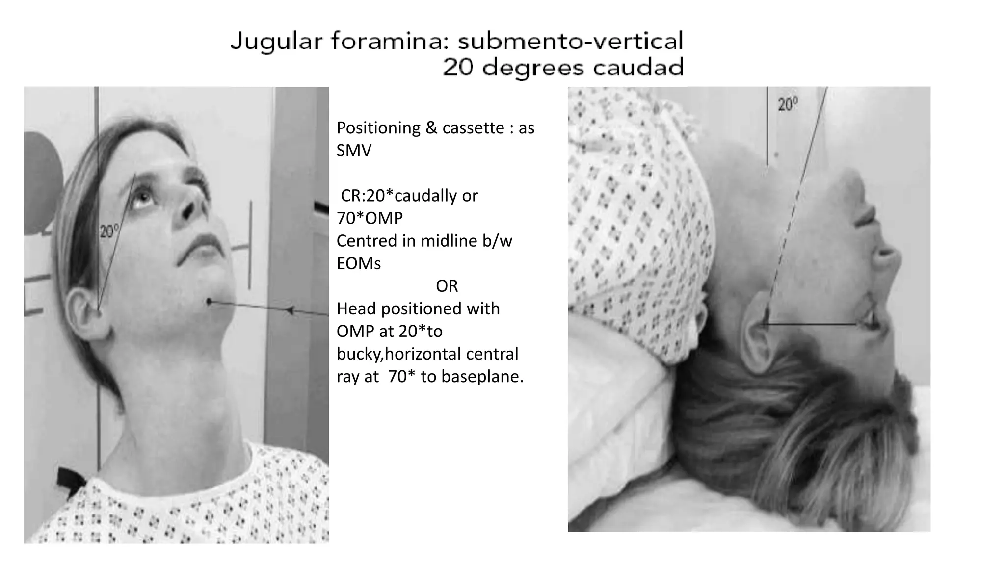 Skull,orbit temporal bones,facial bones,paranasal sinuses,mandible and ...