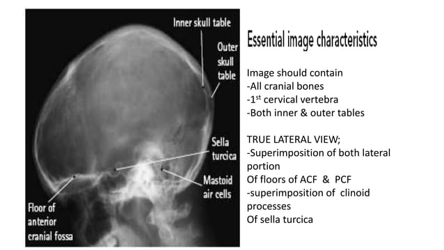 Skull,orbit temporal bones,facial bones,paranasal sinuses,mandible and ...