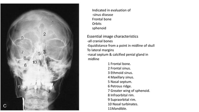 Skull,orbit temporal bones,facial bones,paranasal sinuses,mandible and ...