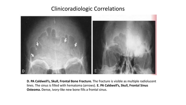 Skull,orbit temporal bones,facial bones,paranasal sinuses,mandible and ...
