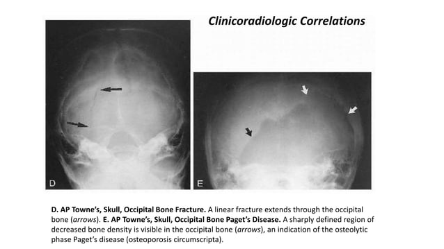 Skull,orbit temporal bones,facial bones,paranasal sinuses,mandible and ...