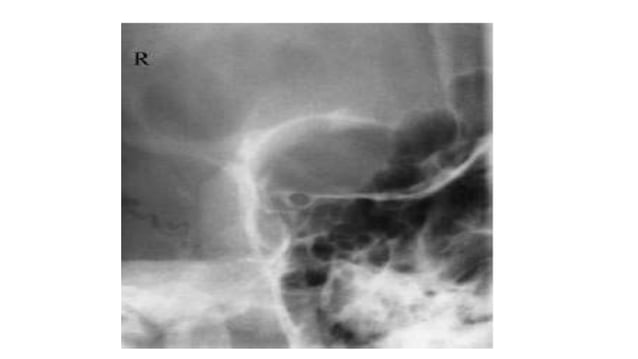 Skull,orbit temporal bones,facial bones,paranasal sinuses,mandible and ...