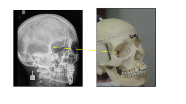 Skull,orbit temporal bones,facial bones,paranasal sinuses,mandible and ...