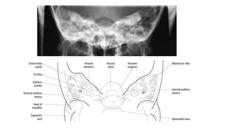 Skull,orbit temporal bones,facial bones,paranasal sinuses,mandible and ...