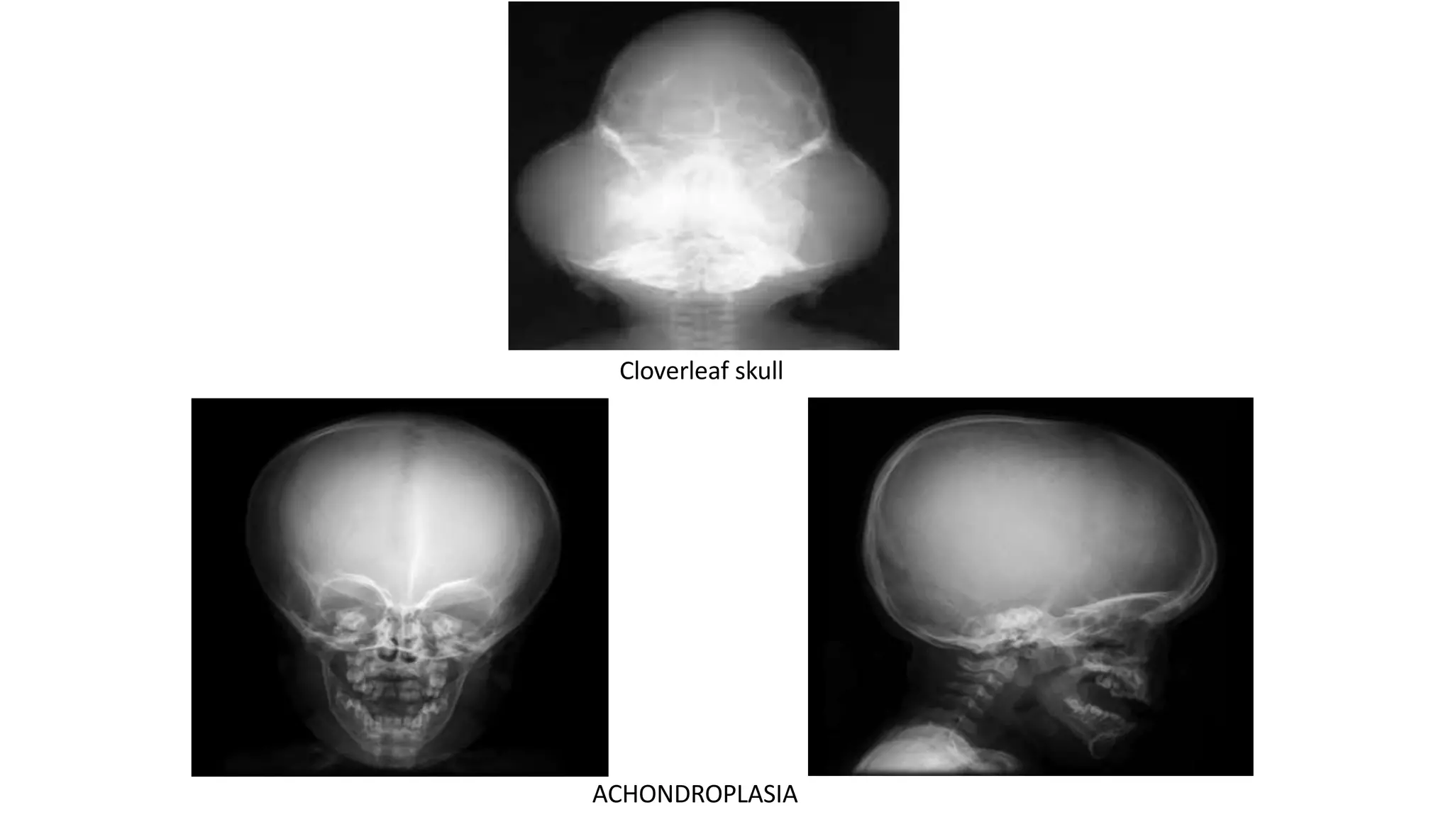Skull pathologies on Xrays | PPTX
