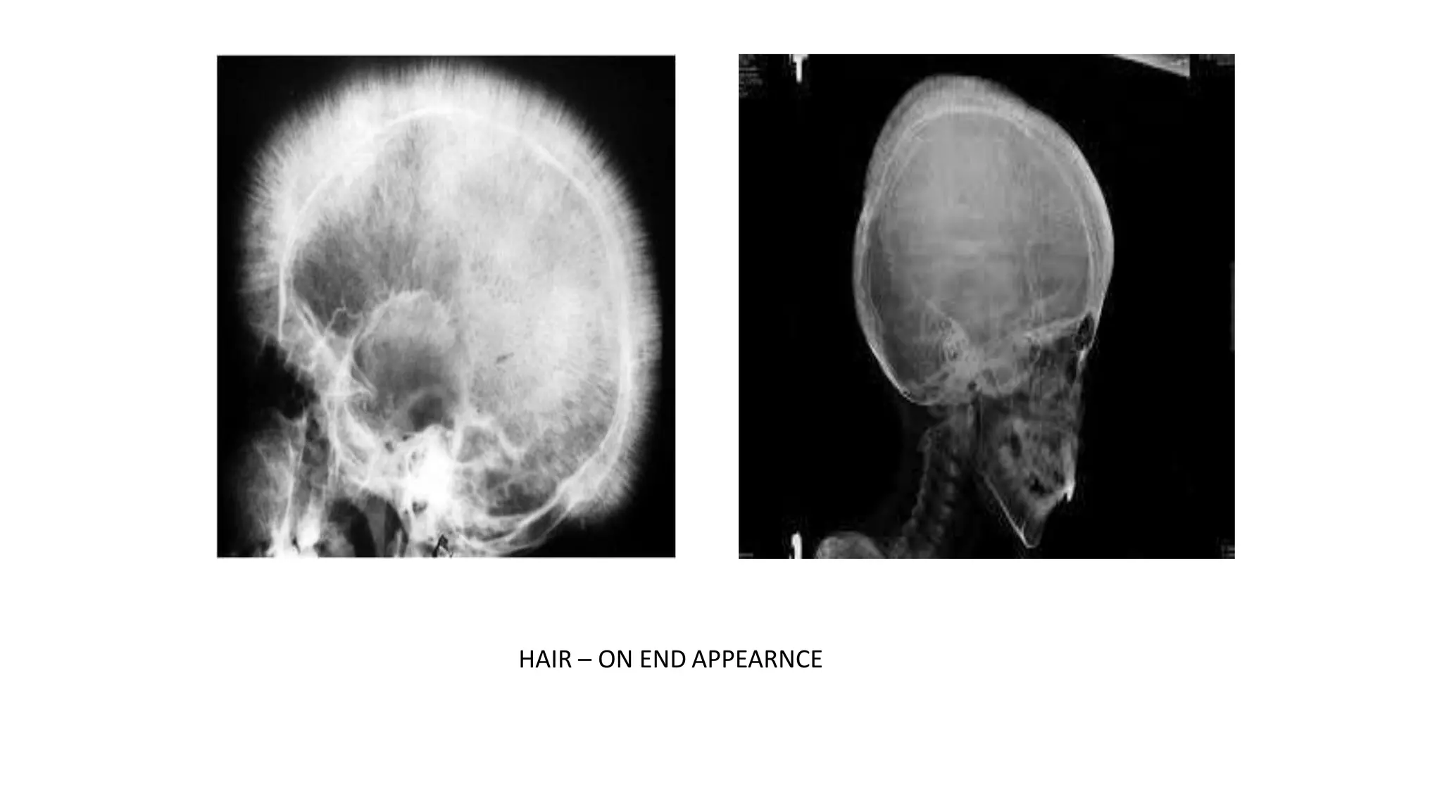 Skull pathologies on Xrays | PPTX