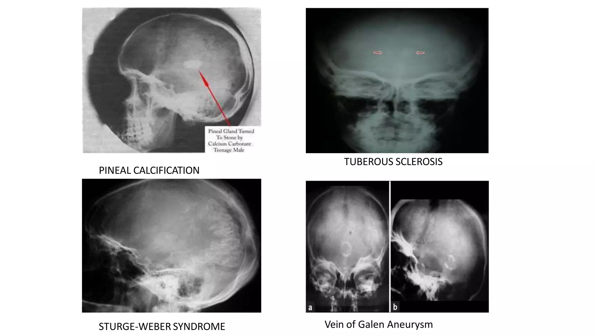 Skull pathologies on Xrays | PPTX