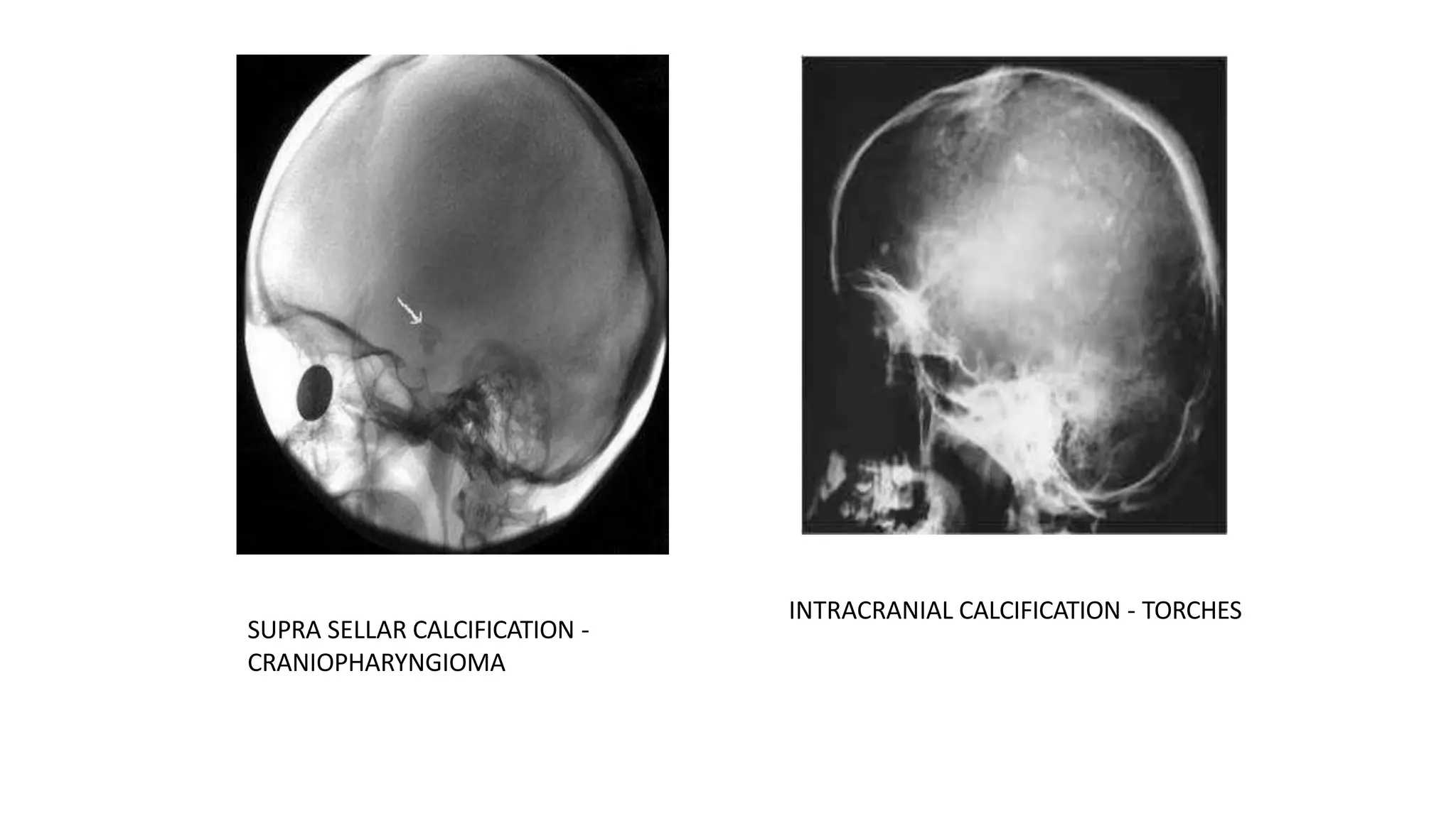 Skull pathologies on Xrays | PPTX