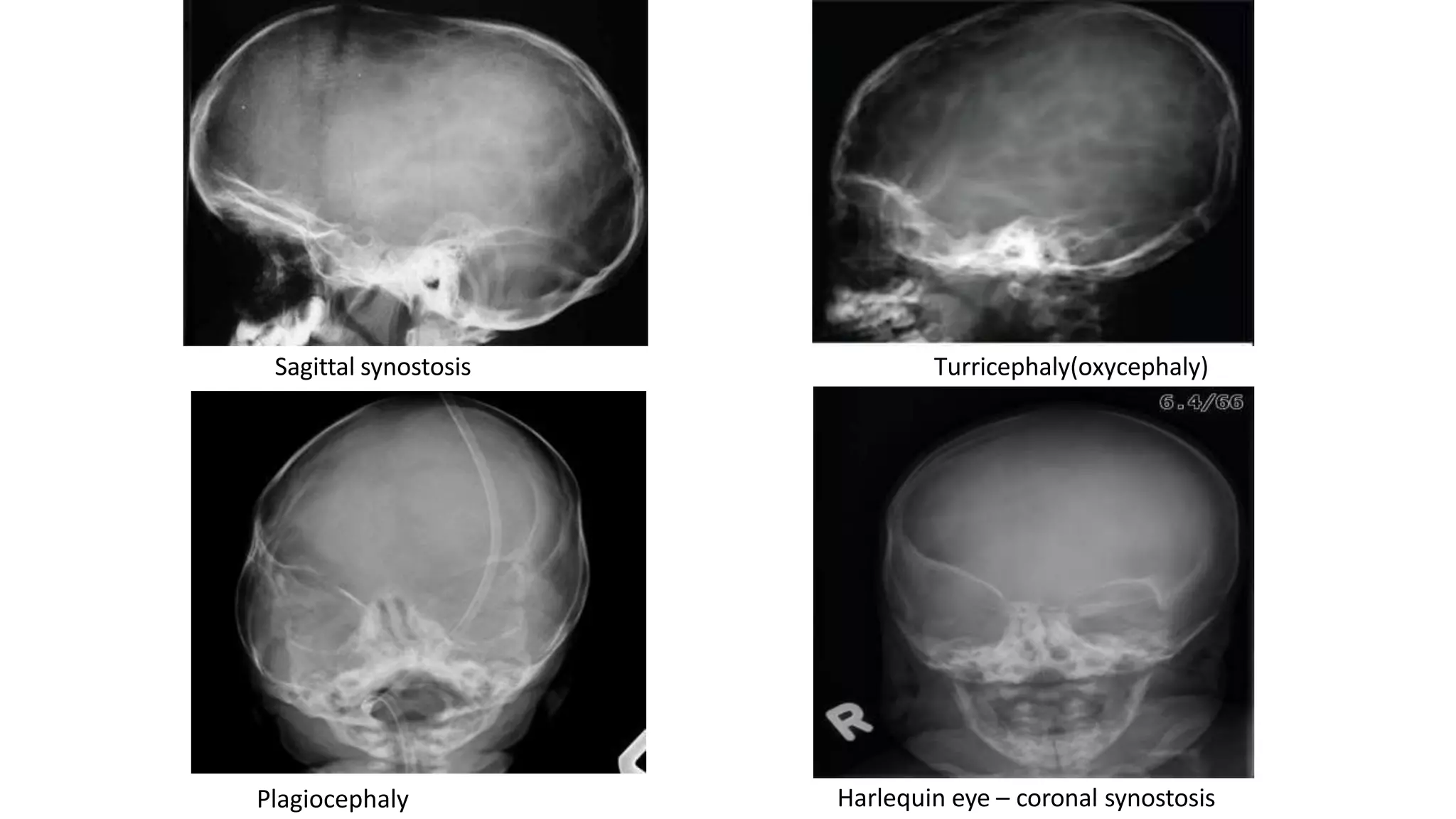 Skull pathologies on Xrays | PPTX | Bone and Joint Conditions ...