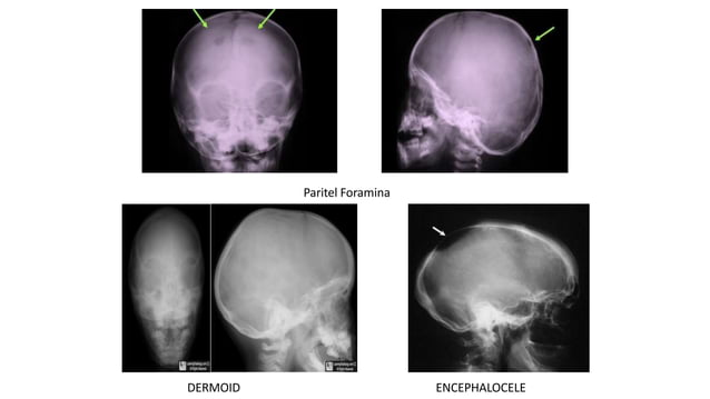 Skull pathologies on Xrays | PPTX | Bone and Joint Conditions ...