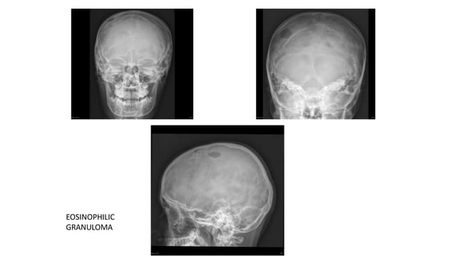 Skull pathologies on Xrays | PPTX | Bone and Joint Conditions ...