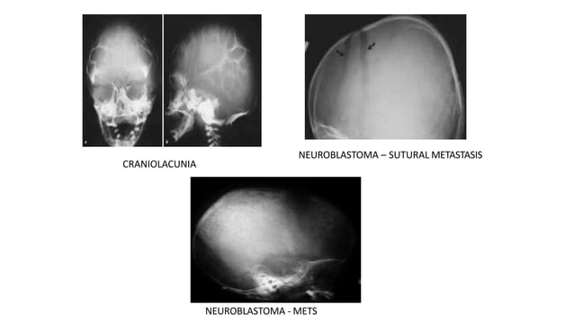 Skull pathologies on Xrays | PPTX | Bone and Joint Conditions ...