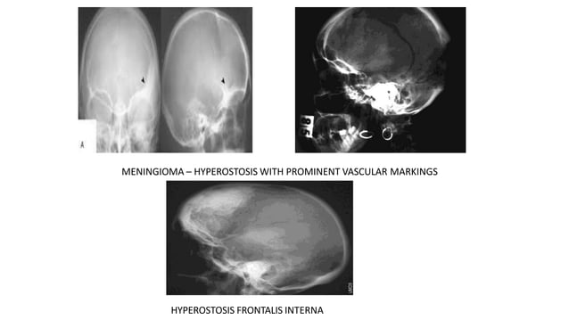 Skull pathologies on Xrays | PPTX | Bone and Joint Conditions ...