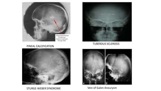 Skull pathologies on Xrays | PPTX