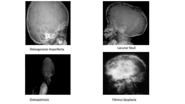 Skull pathologies on Xrays | PPTX | Bone and Joint Conditions ...
