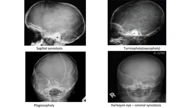 Skull pathologies on Xrays | PPTX | Bone and Joint Conditions ...