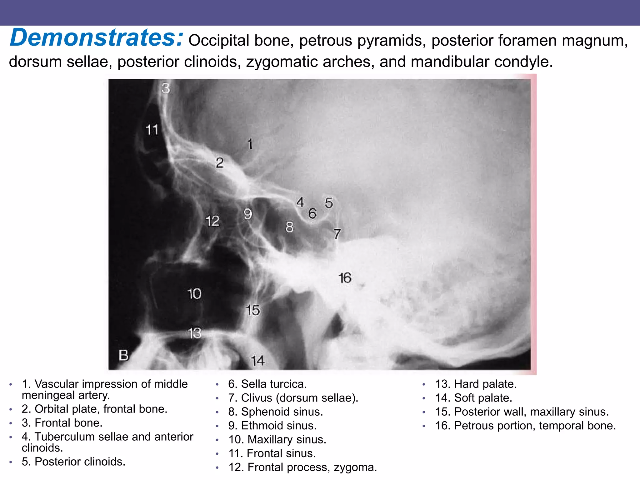 Skull, pns views.pot