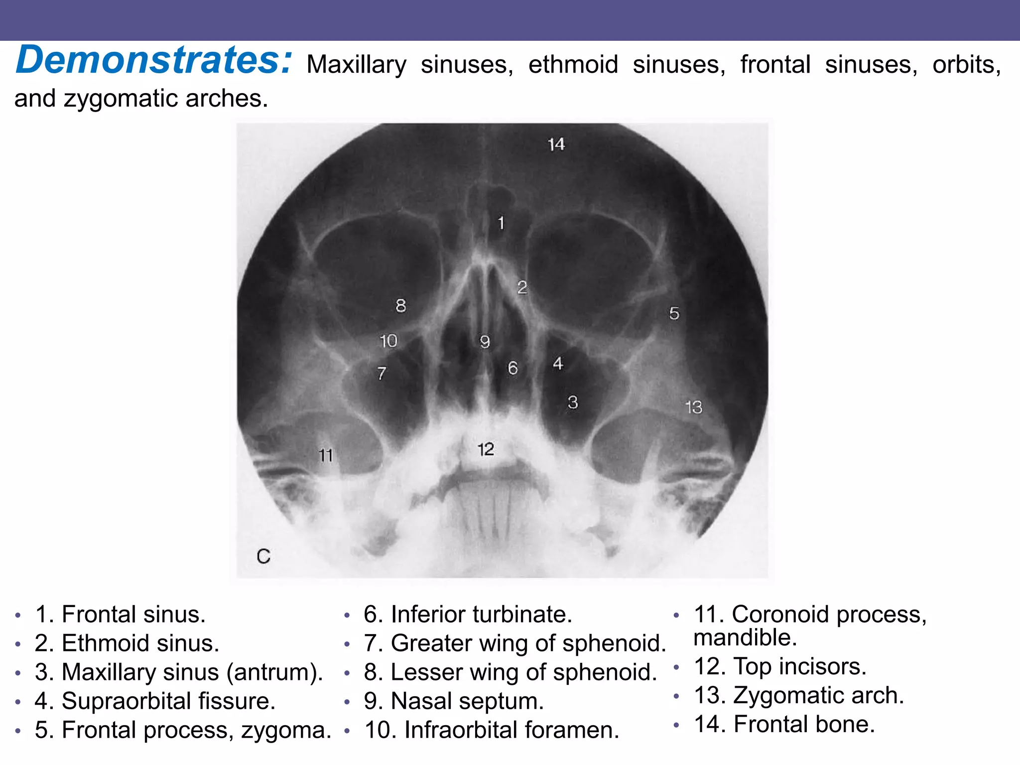 Skull, pns views.pot
