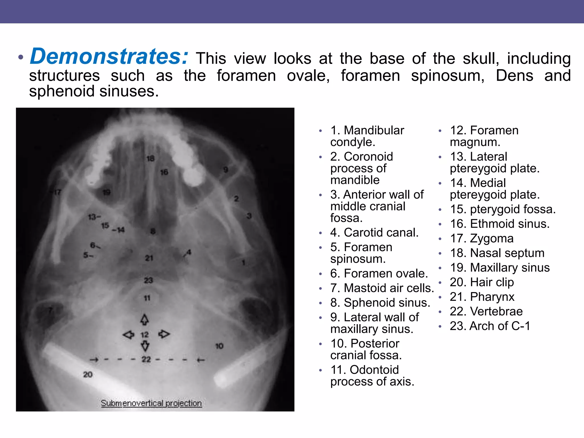 Skull, pns views.pot