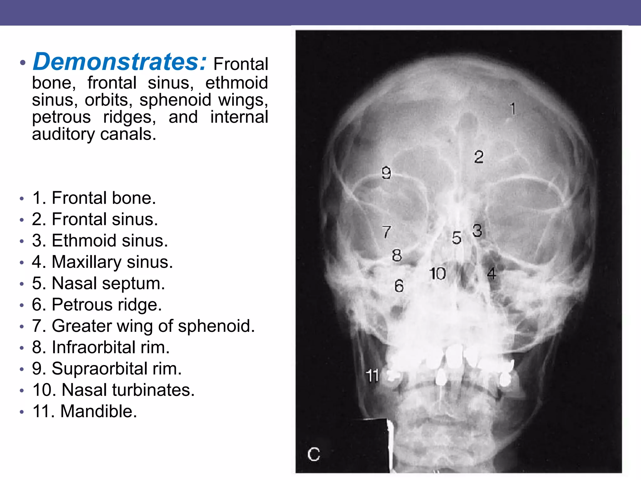 Skull, pns views.pot