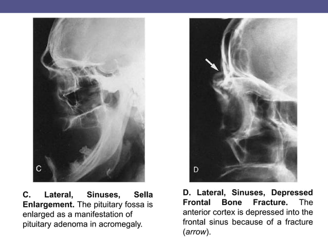 Skull, pns views.pot
