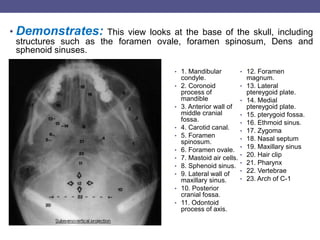 Skull, pns views.pot