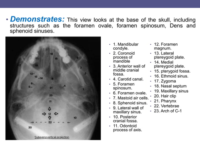 Skull, pns views.pot
