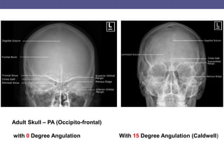 Skull, pns views.pot