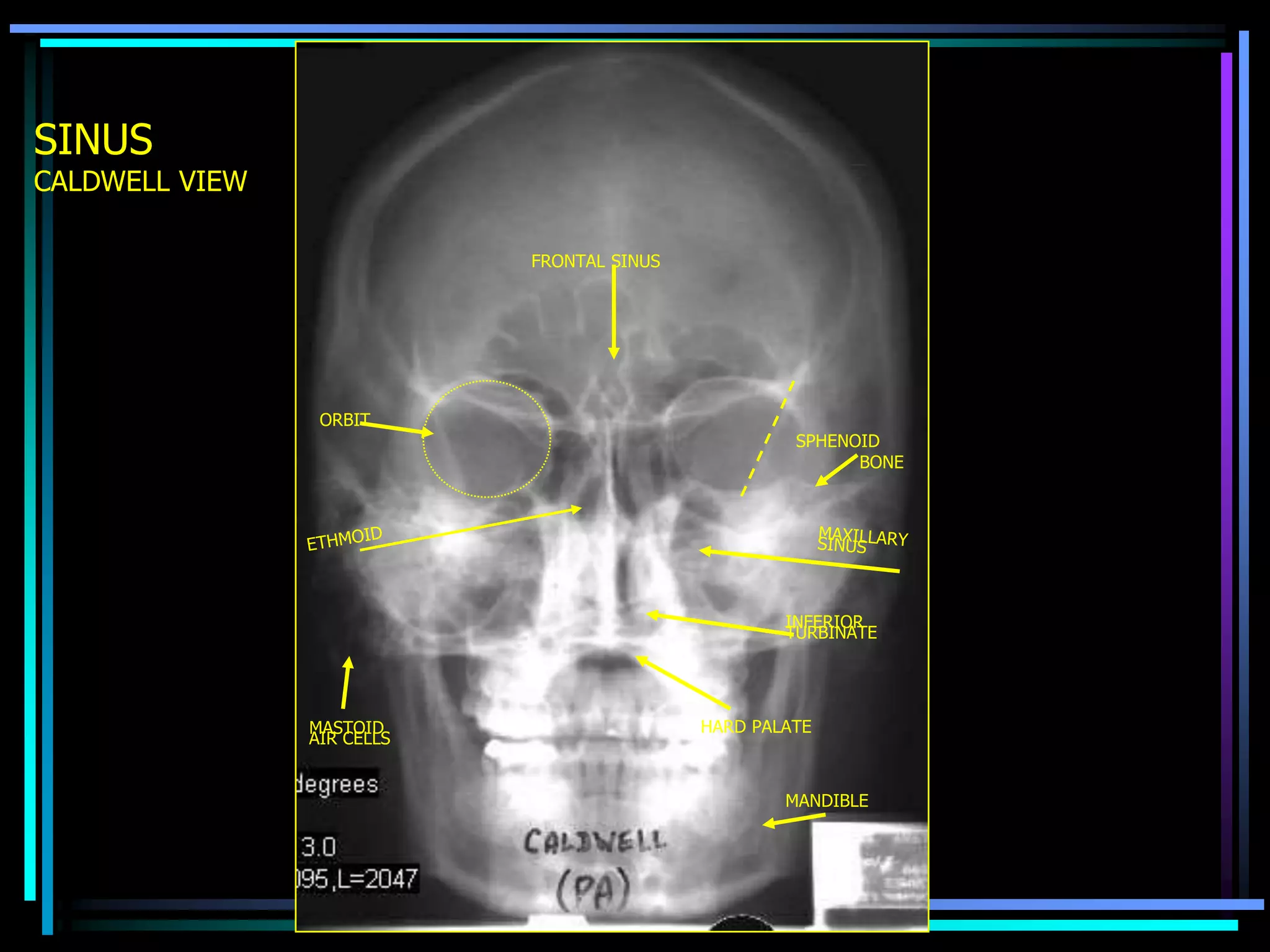 Skull radiography | PPTX