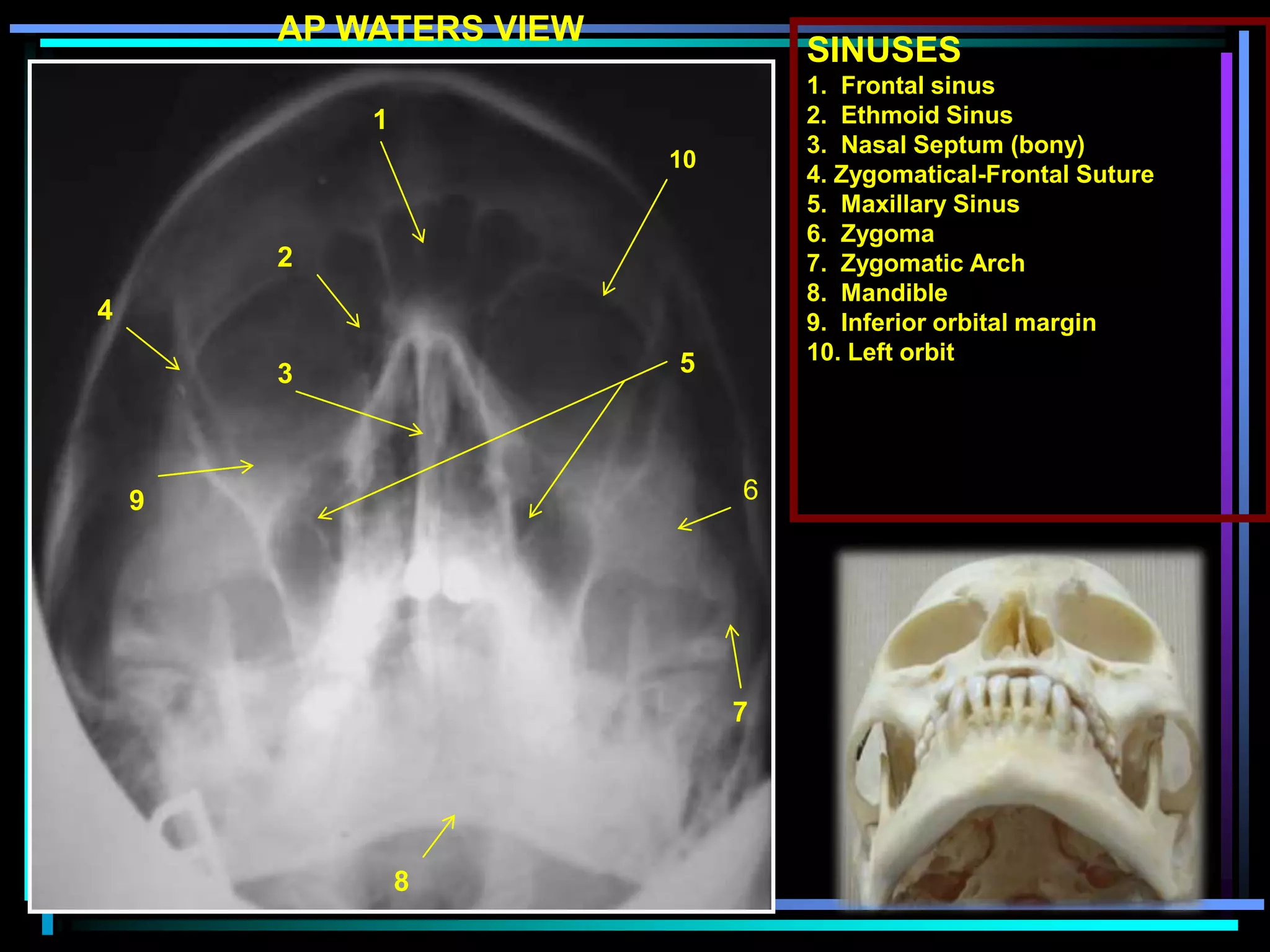 Skull radiography | PPTX