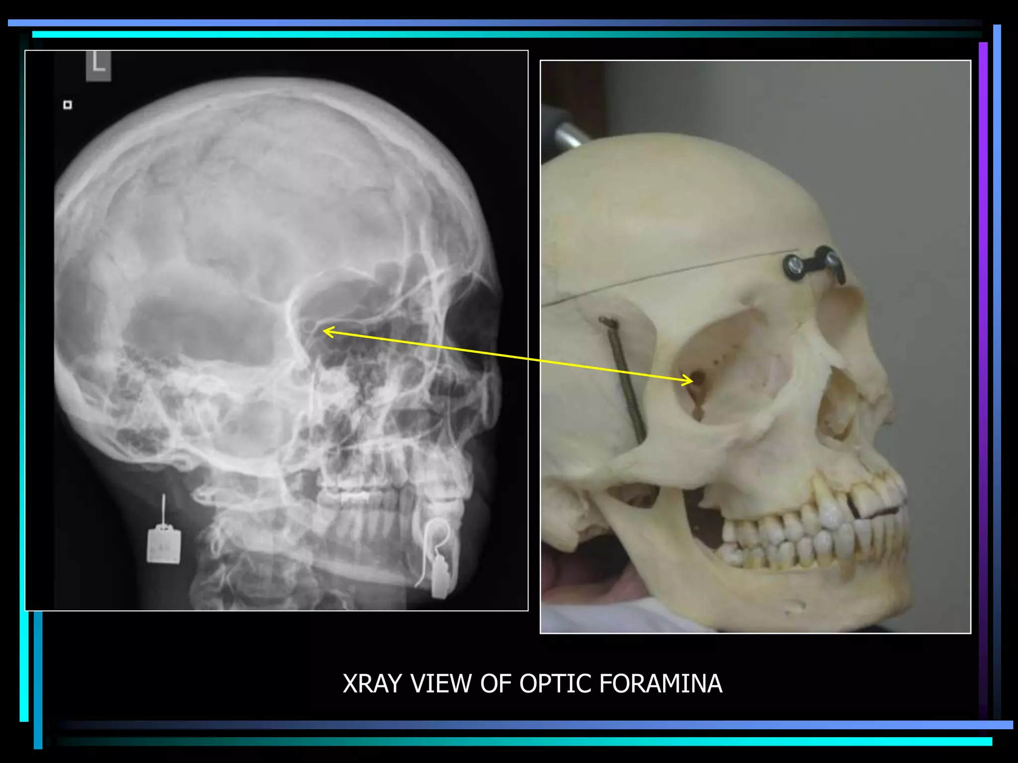 Skull radiography | PPTX