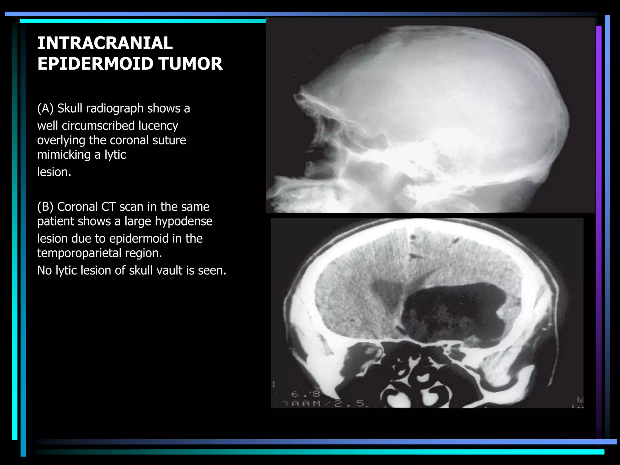 Skull radiography | PPTX