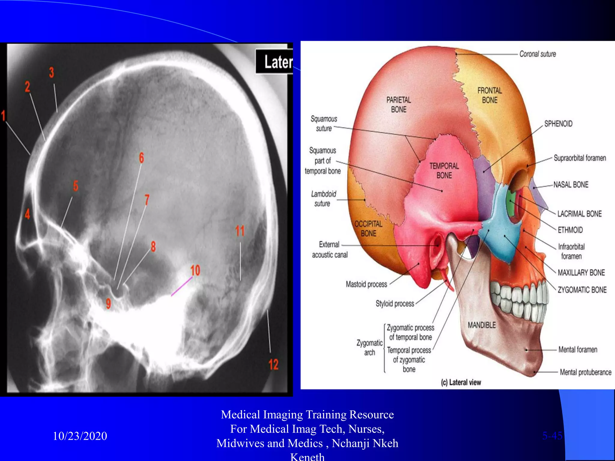 Skull x ray and pathologies radiology training resource nchanji nkeh ...