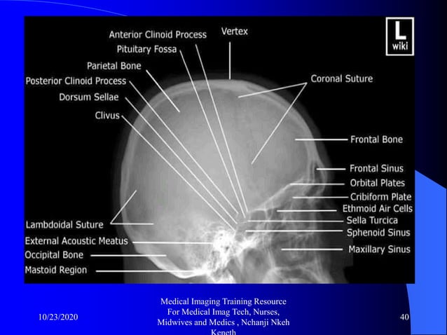 Skull x ray and pathologies radiology training resource nchanji nkeh ...