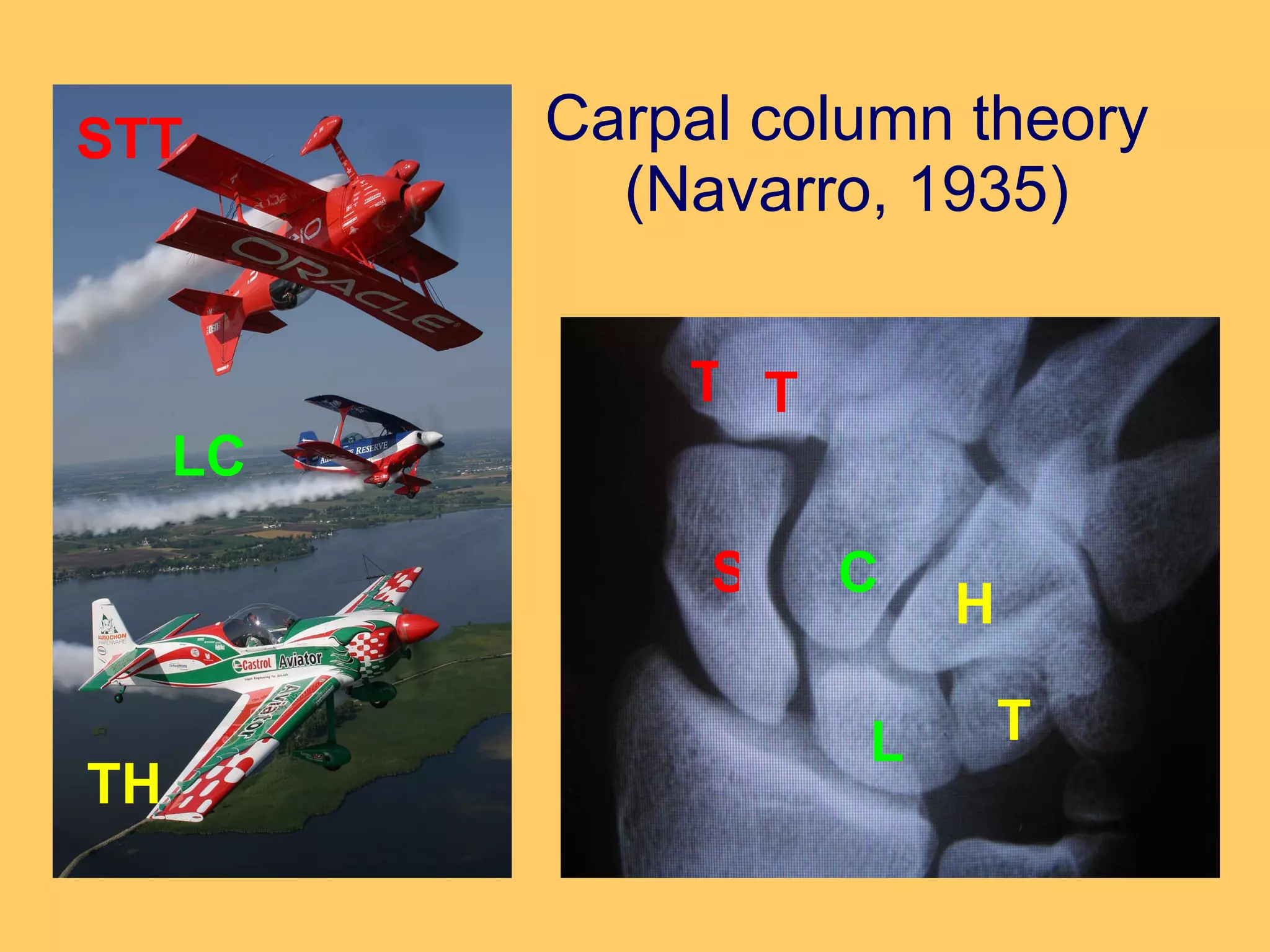 SL and SLC arthrodesis - heretic solutions?, power point | PPT