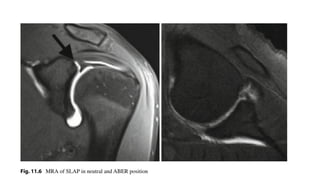 shoulder superior labrum anterior to posterior (SLAP) lesion.pptx