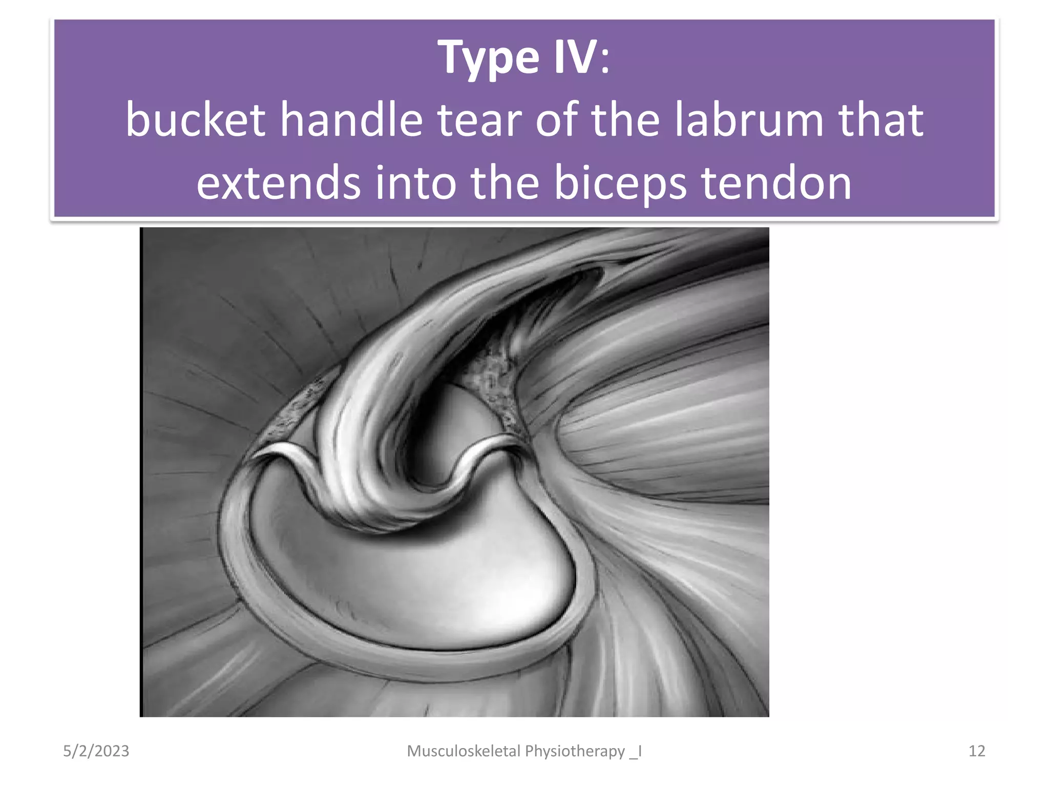 SLAP Lesion and.pdf | Death, Injury, or Military Conflict | Sensitive ...