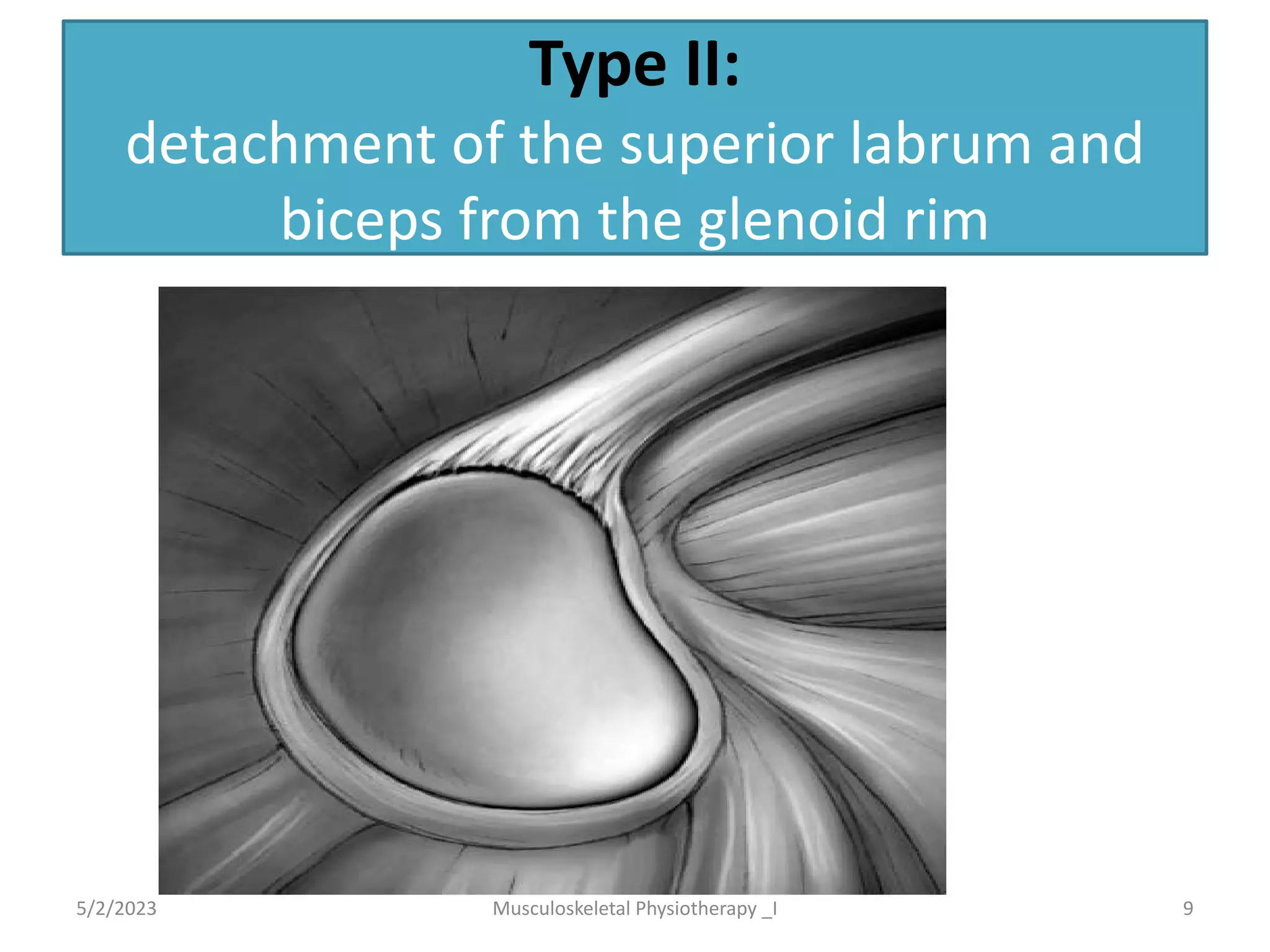 SLAP Lesion and.pdf | Death, Injury, or Military Conflict | Sensitive ...