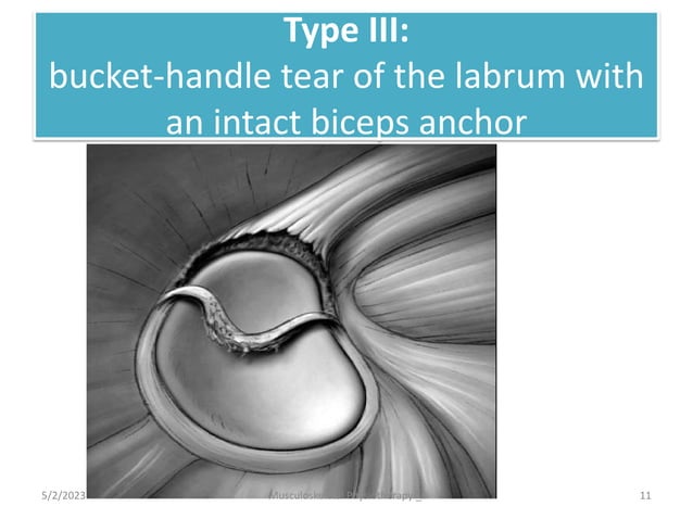 SLAP Lesion and.pdf | Death, Injury, or Military Conflict | Sensitive ...