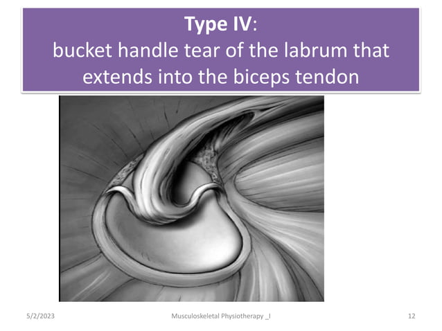 SLAP Lesion and.pdf | Death, Injury, or Military Conflict | Sensitive ...