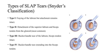 SLAP lesion protocol (MPT).PowerPoint presentation | PPTX