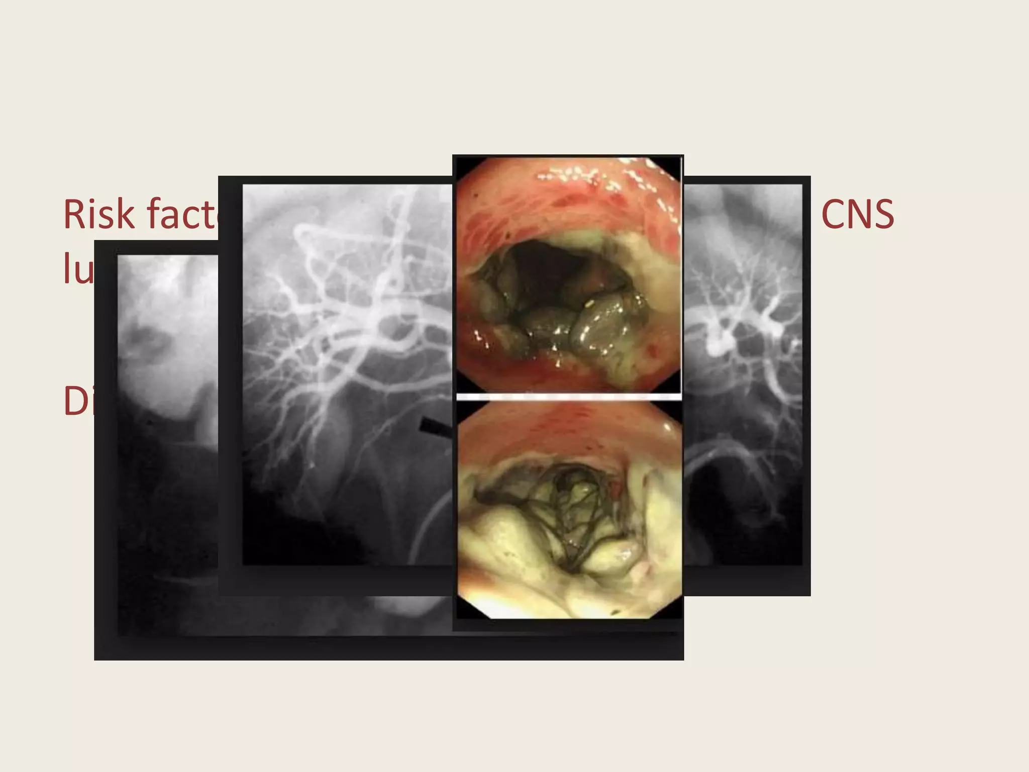 Systemic Lupus and Abdominal Pains | PPTX