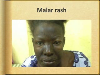 Systemic Lupus Erythematosus - Case Management and Literature Review | PPT