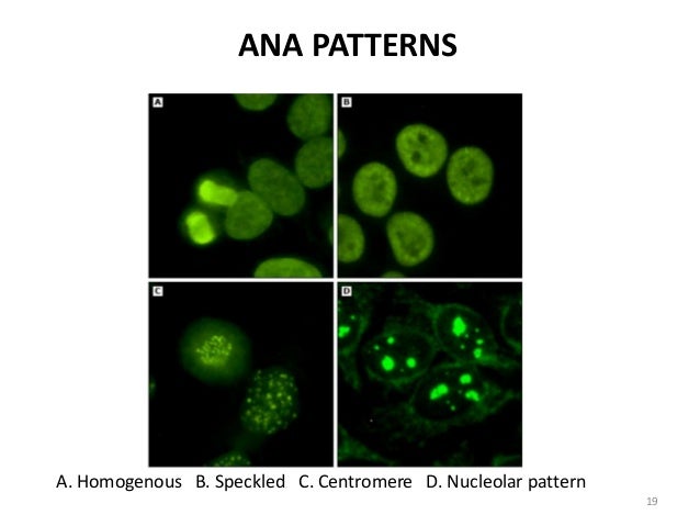 Systemic Lupus Erythematosis
