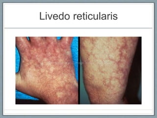 Systemic Lupus Erythematosus by Dr. Daniel B. Yidana | PPTX | Skin and ...